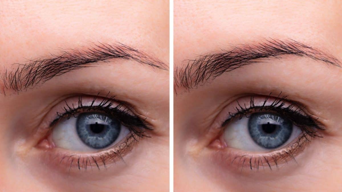 Eyebrow Lift Botox | Botox Brow Lift | Derma Institute